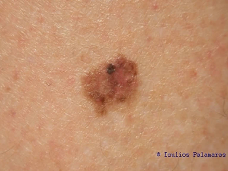 Skin Cancer And Pigmented Skin Lesions Ioulios Palamaras MD PhD Skin Cancer And Pigmented Skin Lesions Ioulios Palamaras MD PhD